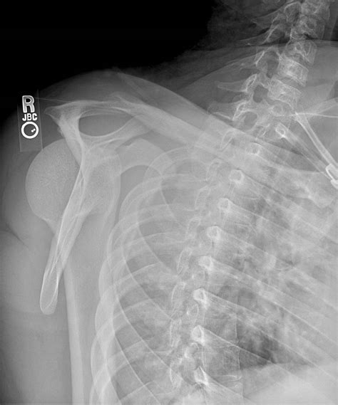 X Ray Shoulder Dislocation 89 Anterior Shoulder Dislocation Images