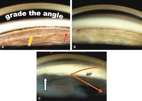 Gonioscopy Structures Gonioscopy Normal Angle 2