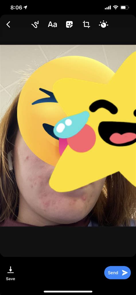 Cystic Nodular Pimples In The Same Are Skin Concern