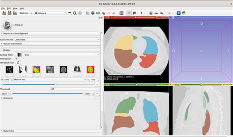 Lung Lobe Segmentation Using 3d Slicer Support 3d Slicer Community