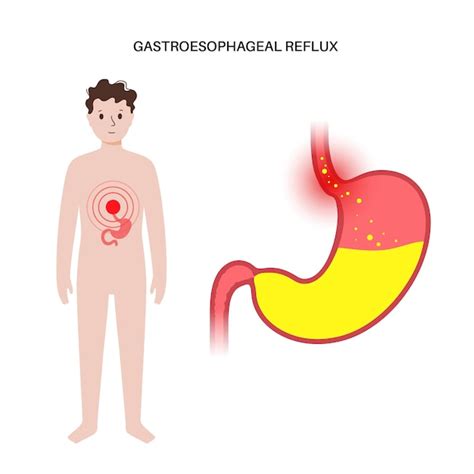 Enfermedad Por Reflujo Gastroesofágico Niño En Clínica Trastorno