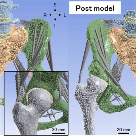 Finite Element Models Of The Preoperative Left And Postoperative