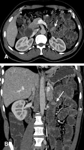 Jejunal Villous Adenoma A 42year Old Male Presenting With Obscure Gi