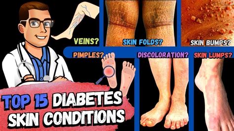 Top 15 Diabetes Skin Signs And Symptoms Type 2 And 1 Diabetes Mellitus