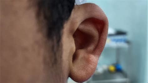 عملية تجميل الاذن البارزة لايف الاذن الخفاشية صوان الاذن أحسن طبيب تجميل مصر Otoplasty