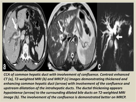 Presentation1 Pptx Radiological Imaging Of Cholangiocarcinoma Ppt