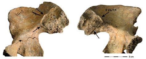 Pubic Tubercle Tridimensional Pelvis Reconstruction Showing The