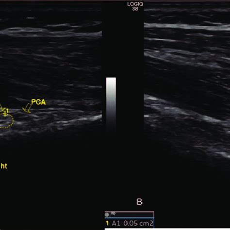 Axillary Nerve Block In Quadrangular Space Under The Guidance Of