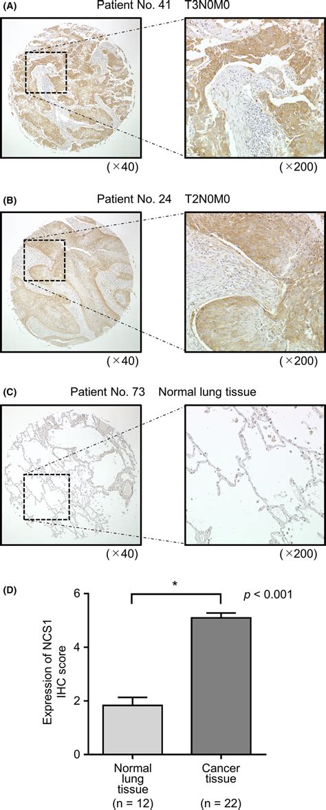 Expression Of Neuronal Calcium Sensor 1 Ncs1 In Clinical Lung Download Scientific Diagram