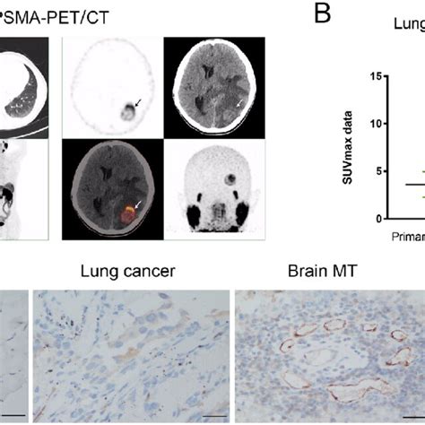 The Expression Of PSMA Prostate Specific Membrane Antigen PSMA In Download Scientific Diagram