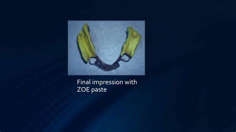 Impression In Rpd Pptx Dental Health Diseases And Conditions