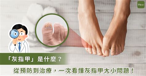 灰指甲怎麼治療、預防，頻繁復發怎麼辦？8 大問題一次說清楚！ Heho健康
