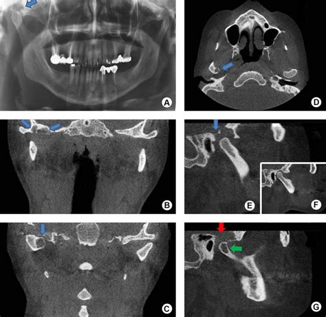 Imaging Aspects Of The Lesion A Panoramic Radiograph Showing A Lesion Download Scientific