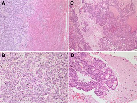 Patient With Intrahepatic Cholangiocarcinoma With A Single Brain Download Scientific Diagram