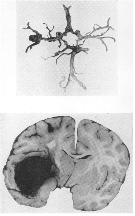 Figure 3 From The Management Of Ruptured Intracranial Aneurysm