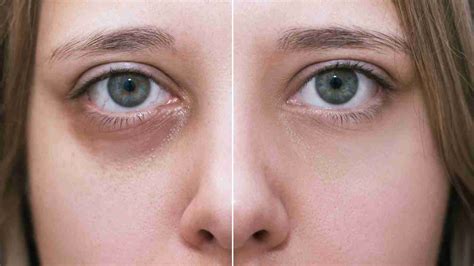 Sunken Eyes Dark Circles