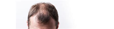 Diffuse Unpatterned Alopecia In Indians Causes And Treatments