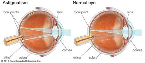 A Visual Explanation Of Astigmatism