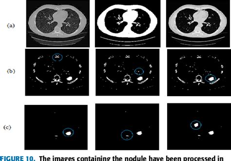 Figure 10 From Design Of Automatic Lung Nodule Detection System Based