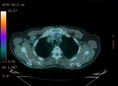 Appendiceal Adenocarcinoma Complicated By Retroperitoneal Abscess