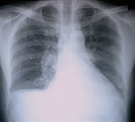 Subpulmonic Effusion
