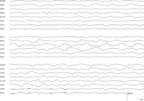Delta Activity Neupsy Key