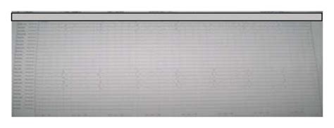Low Voltage Eeg Recording With Multiple Ecg Artefacts Download Scientific Diagram