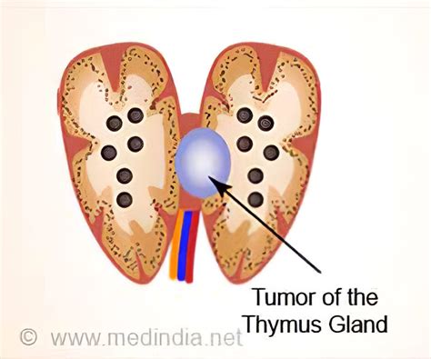 Thymic Tumor