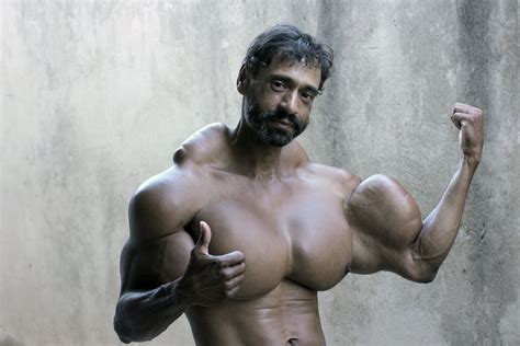Synthol Chest Injections