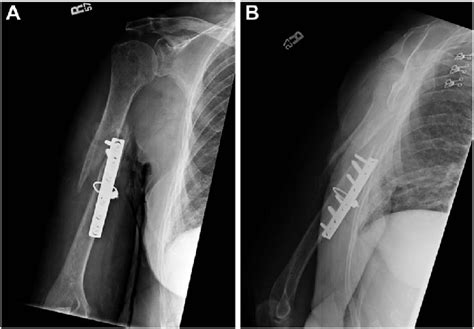 Anteroposterior A And Lateral B Radiographs Of The Humerus In A