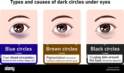 What Are Dark Circles Under Eyes From At David Rogge Blog