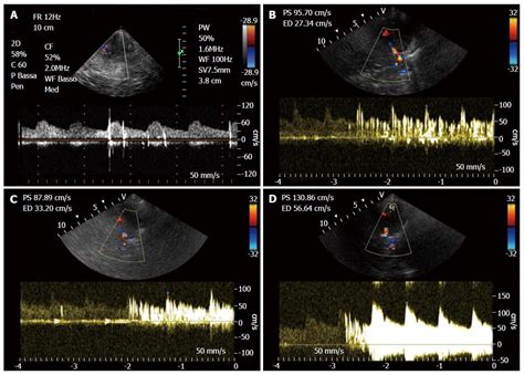 Transcranial Doppler Ultrasonography From Methodology To Major