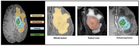 Self Supervised Wavelet Based Attention Network For Semantic Segmentation Of Mri Brain Tumor