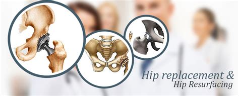 Hip Resurfacing Vs Hip Replacement Know The Difference