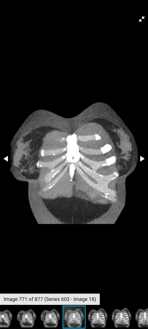 Slipping Rib Syndrome And Bridging Cartilage Fracture