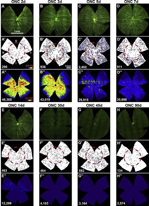 Topographical Loss Of Intraretinal Axons And Rgcs And Appearance Of