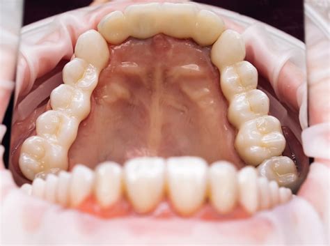 Premium Photo Ceramic Teeth With The Implant On A Plaster Model