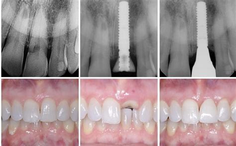 Dental Implants Dental Implants And Periodontics Of Ct