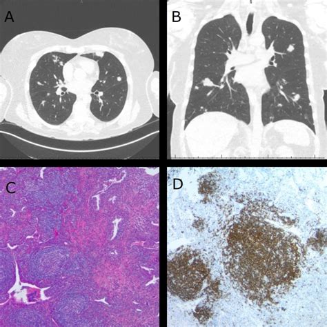 Bilateral Pulmonary Nodules In A Patient With Extensive Autoimmune Disease Thorax