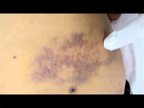 Bruise Bruises Meaning In Hindi Ecchymosis Bluish Discolouration Of Skin After Trauma YouTube