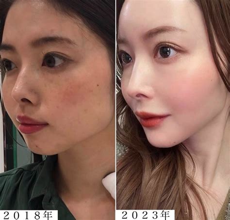 肌メンテはほぼセルフ。定期的に通うエステやクリニックは無し。ここまで変われたのはこの8つを徹底したから。 腸活 顔脱毛 化粧水3回づけ 水を1日1 5ℓ飲む 365日紫外線対策 絶対に摩擦を