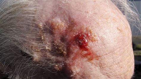 Squamous Cell Carcinoma Early Stages
