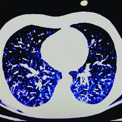Cect Of The Thorax Showing Presence Of Innumerable Miliary Nodules Download Scientific Diagram