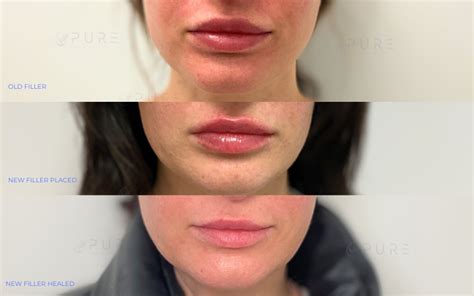 Learn About Lip Filler Side Effects And Risks — Top Rated Scottsdale
