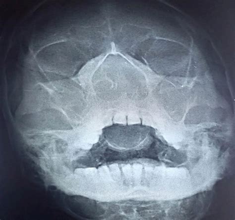 A Rare Case Of Sinonasal Sarcoma With Intracranial Extension A Case
