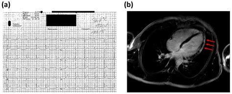 From Streptococcal Pharyngitistonsillitis To Myocarditis A Systematic