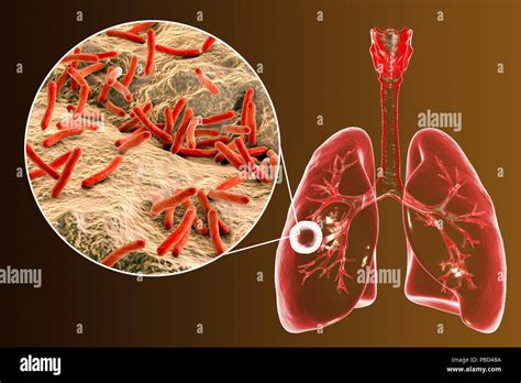 Mycobacterium Tuberculosis Lungs
