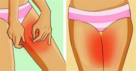 7 Ways To Deal With Vaginal Chafing