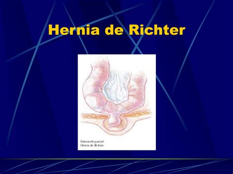 Ppt Hernia Inguinal Powerpoint Presentation Free Download Id1731878