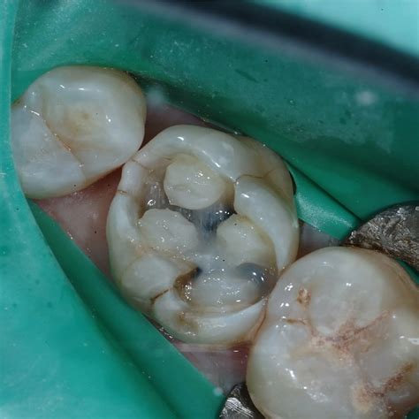 Stress Reduced Direct Composite Restorations Srdc — Alleman Center Of Biomimetic Dentistry